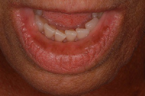 Lips Discoloration And Its Effect - 9jastreet.com